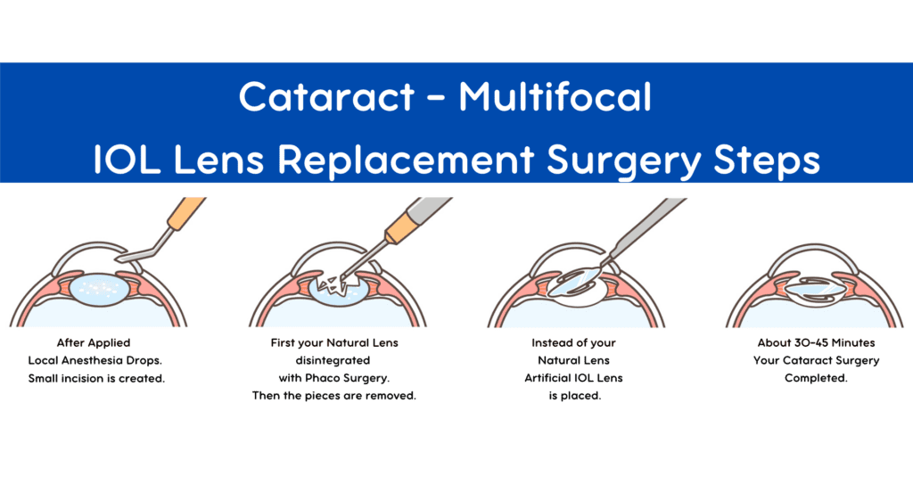 Monofocal Cataract Surgery - Mersin Vizyon Göz Hastanesi