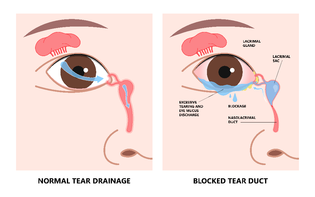 Blocked Tear Duct Surgery - Mersin Vizyon Göz Hastanesi