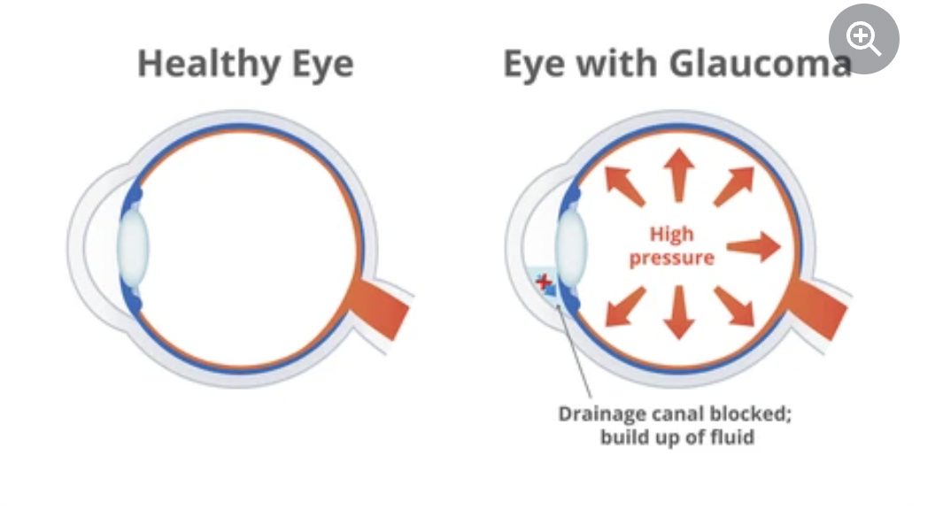Glaucoma Eye Disease Treatments - Mersin Vizyon Göz Hastanesi