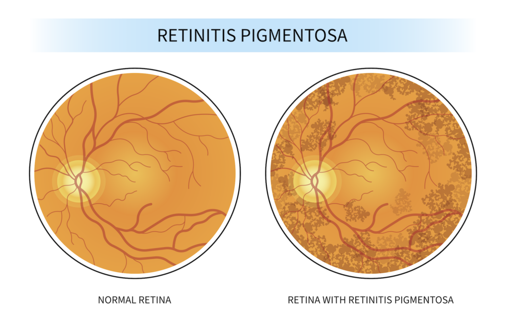 Retinitis Pigmentosa Treatments - Mersin Vizyon Göz Hastanesi