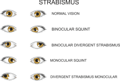 Squint Eye Surgery - Strabismus - Mersin Vizyon Göz Hastanesi
